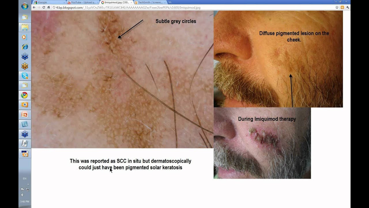 Dermoscopy Made Simple - SCC in situ and Pigmented Bowen's disease ...