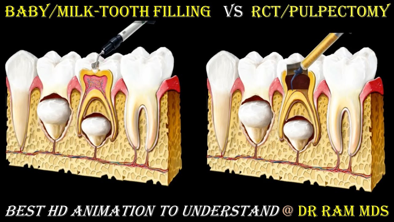 Kids Tooth Decay/Cavity in Milk Teeth - Filling or RCT??🤔 EVERYTHING ...