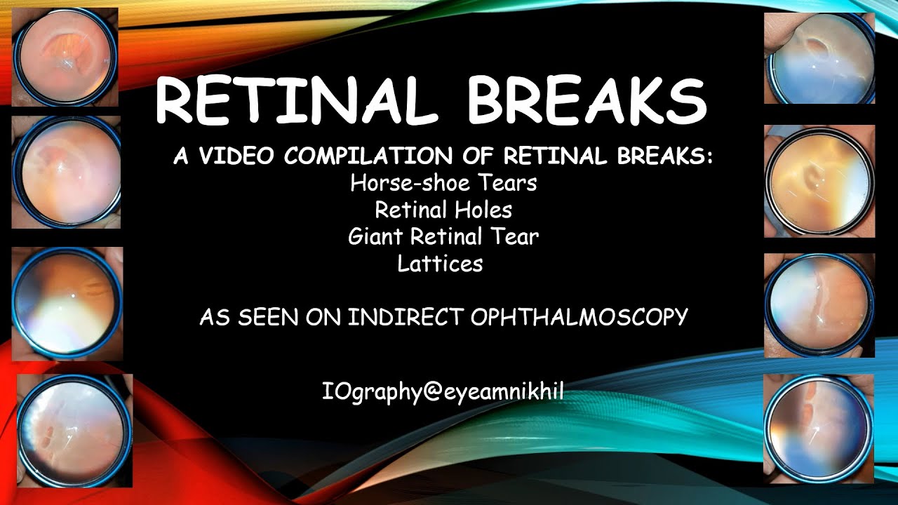 Retinal breaks as seen on indirect ophthalmoscopy : a video compilation ...