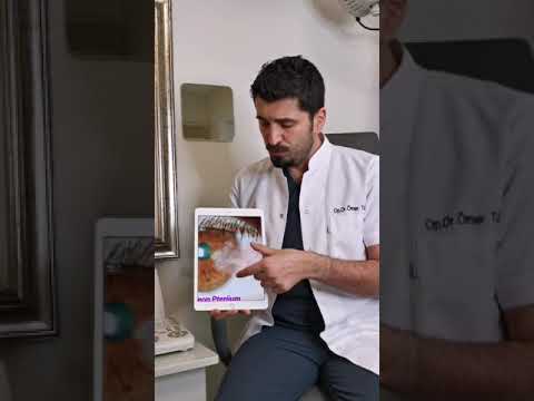 Pterjium (kuş kanadı) tedavisi?