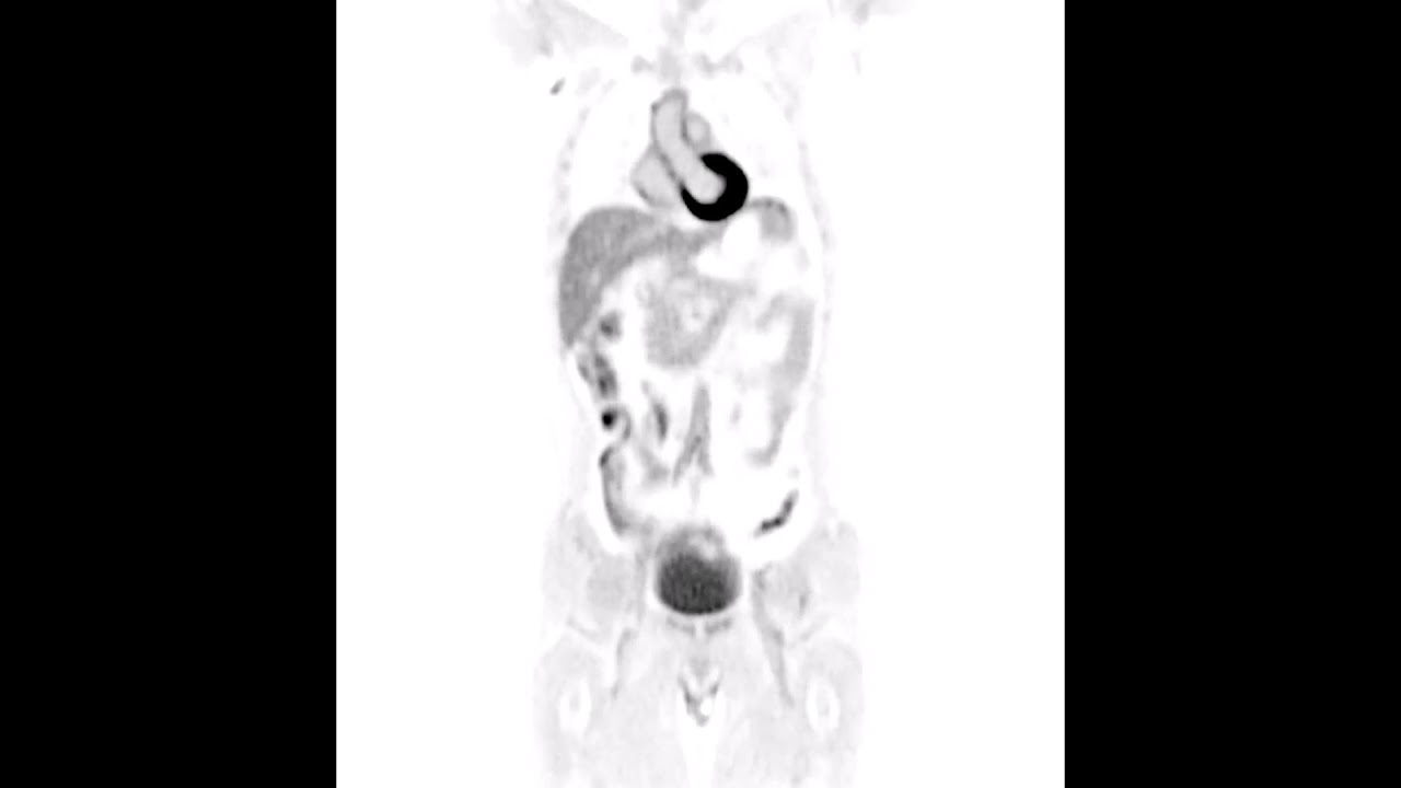 High-resolution EXPLORER Total Body PET scan - YouTube