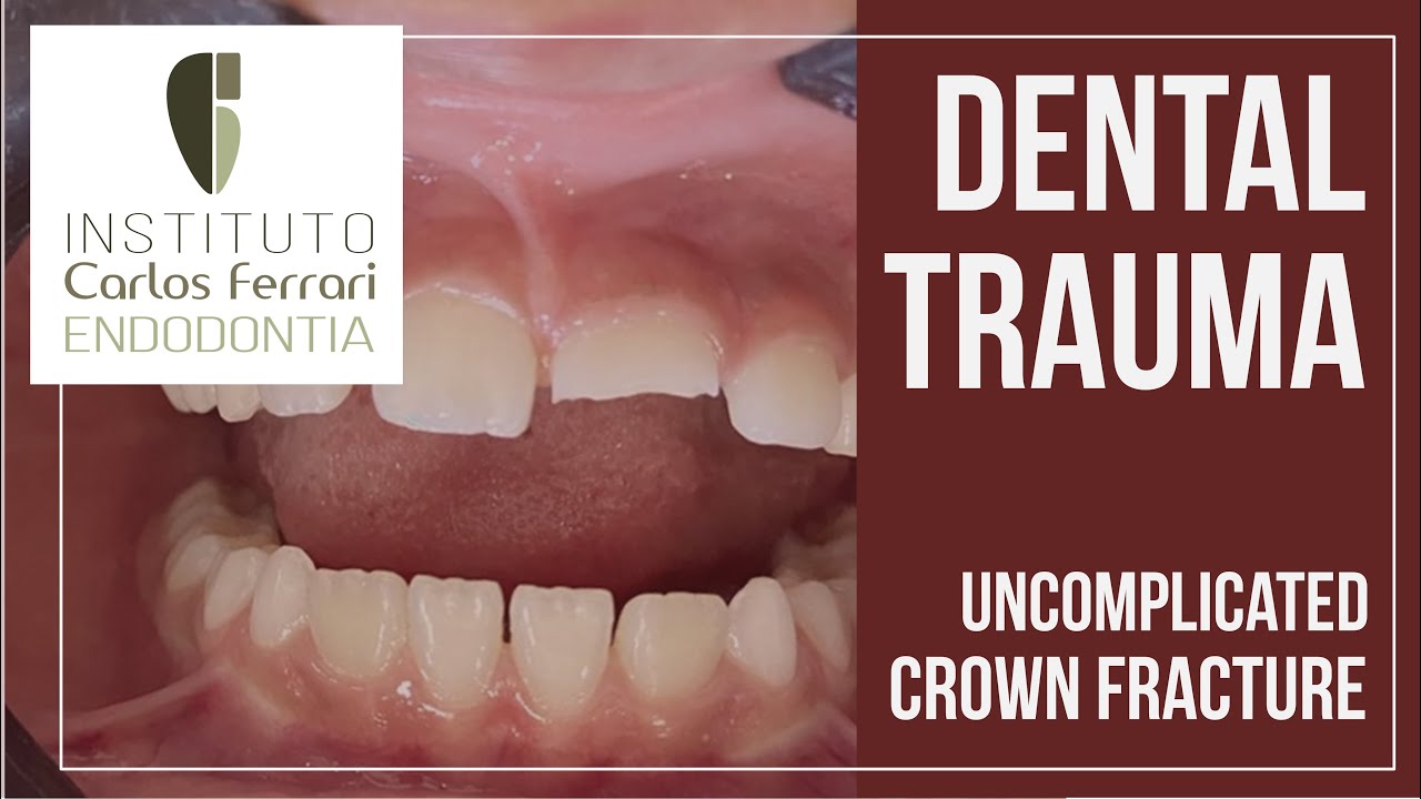 Dental Trauma. Uncomplicated crown fracture - YouTube