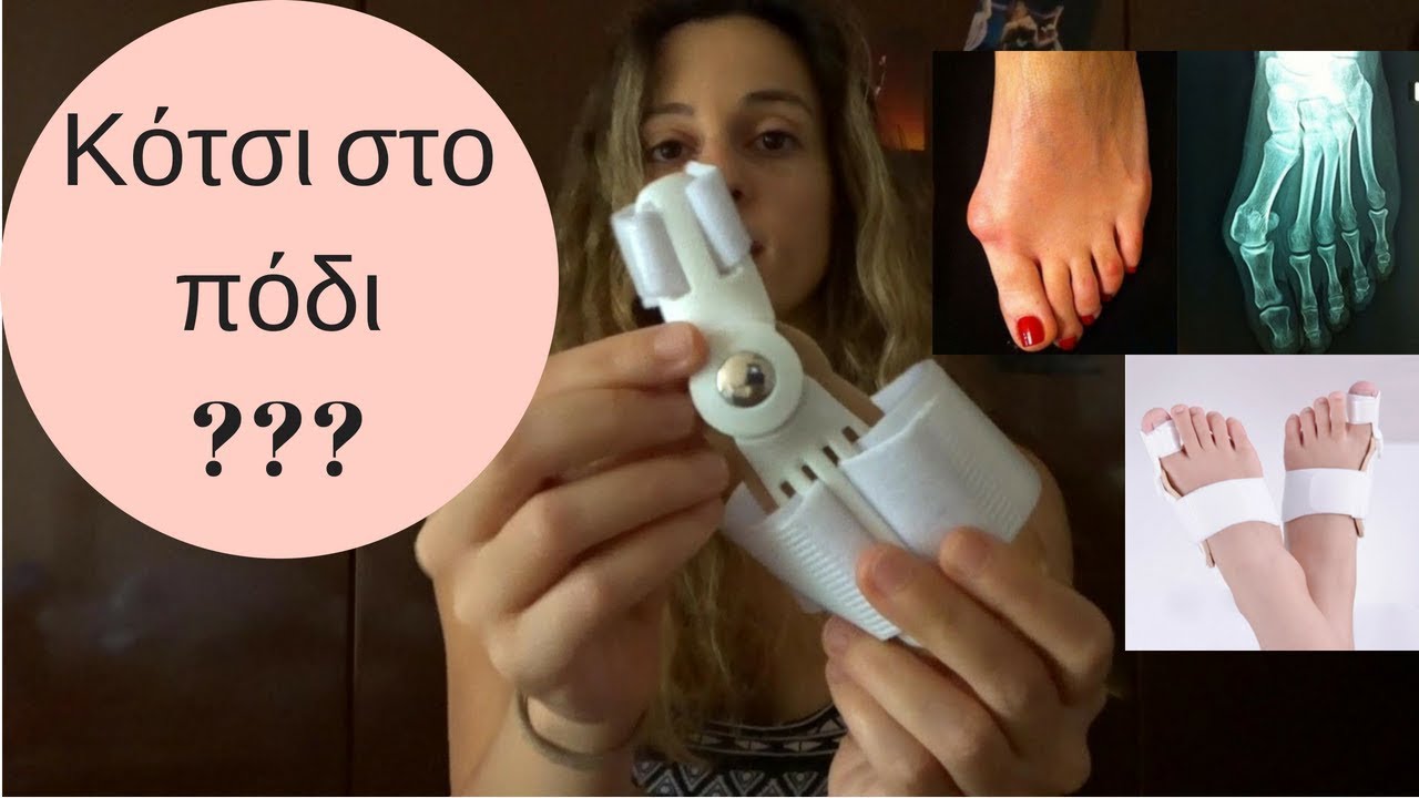 Νάρθηκας για το κότσι| βλαισός μέγας δάκτυλος - YouTube
