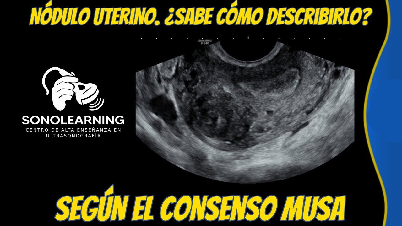 DESCRIPCION ECOGRAFICA DE UN NODULO UTERINO - YouTube