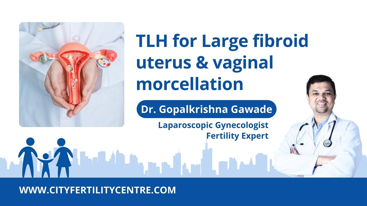 Total Laparoscopic Hysterectomy for Large fibroid uterus & vaginal ...
