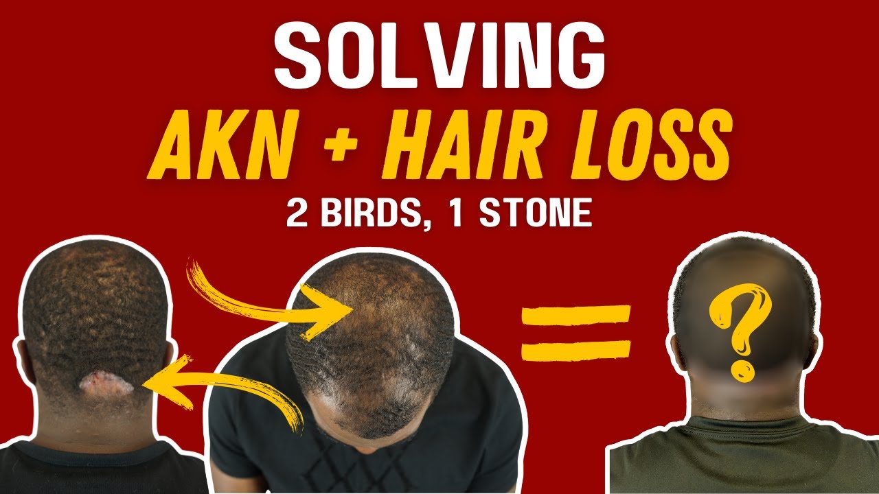 Tackling AKN and Hair Loss with Dr. U - YouTube