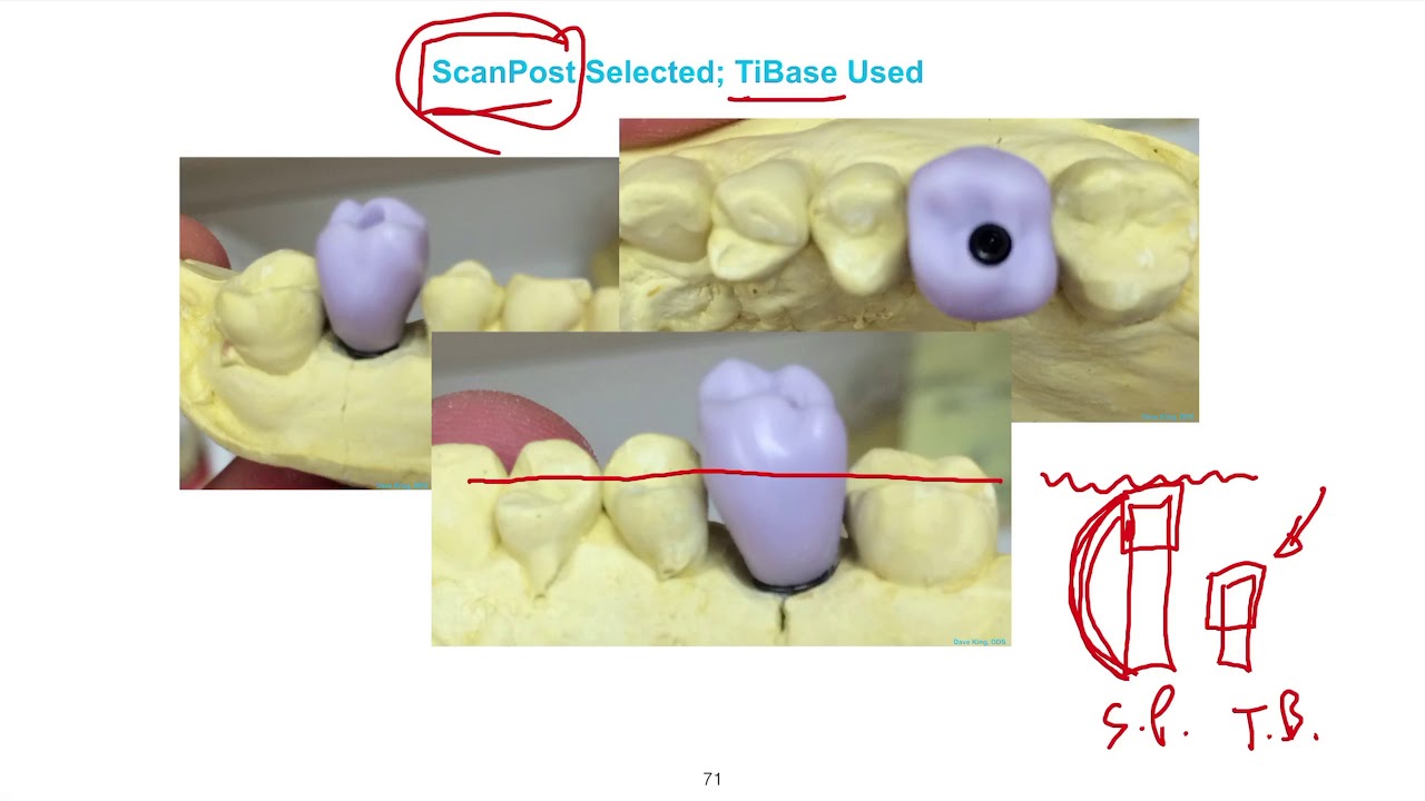 CEREC TiBase Lecture Series Lesson 05 - YouTube