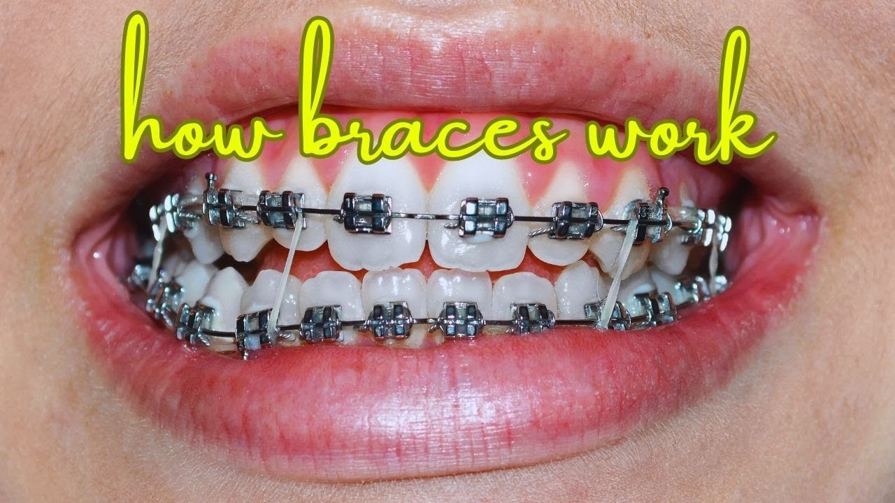 How Braces Work | 3d animated video |Orthodontists |Dentists| Human ...