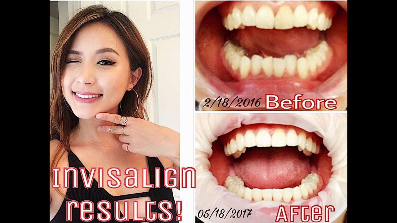 My Invisalign Experience｜隐适美隐形牙套的经验分享 - YouTube