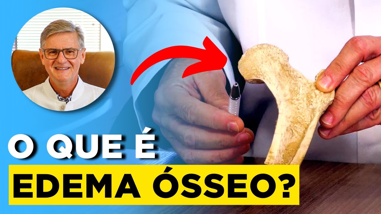 Edema Ósseo (Sintomas, Diagnósticos e Tratamentos) | Robert Wagner ...