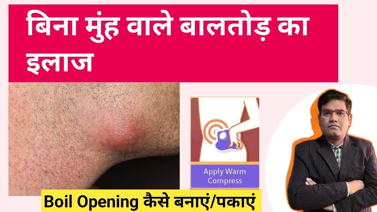 बालतोड (Boil) को पकाने के उपाय | बिना मुंह वाले Boil का इलाज.. - YouTube