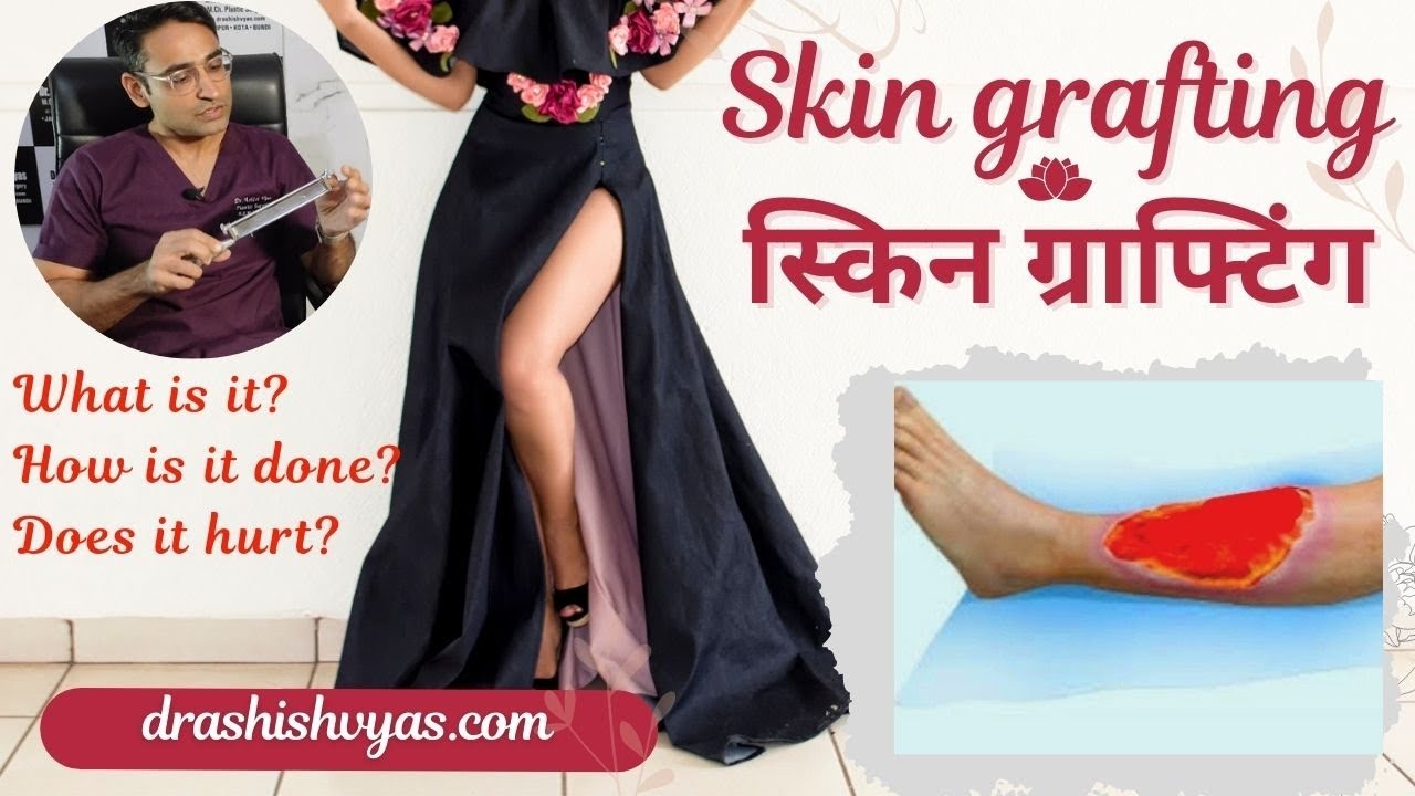 Skin Grafting स्किन ग्राफ्टिंग for wound, bed sore, diabetic ulcer skin ...