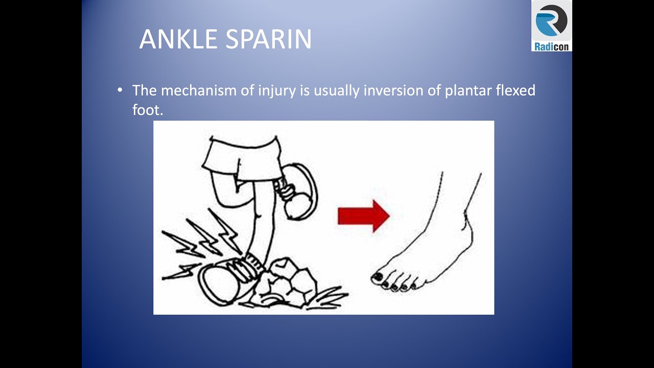 Ankle MRI 2: Ankle Sprain - YouTube