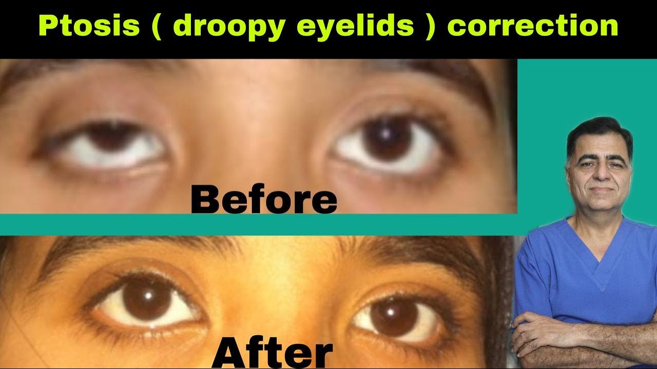 Droopy upperlid (Ptosis) surgery in Kanpur || Dr.S.K. Gulati - YouTube