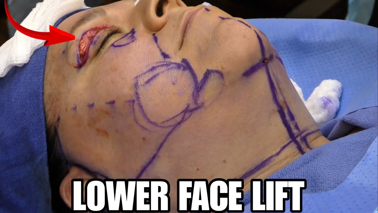 Lower Face Lift Surgery Performed by Dr. Mark Jabor - YouTube
