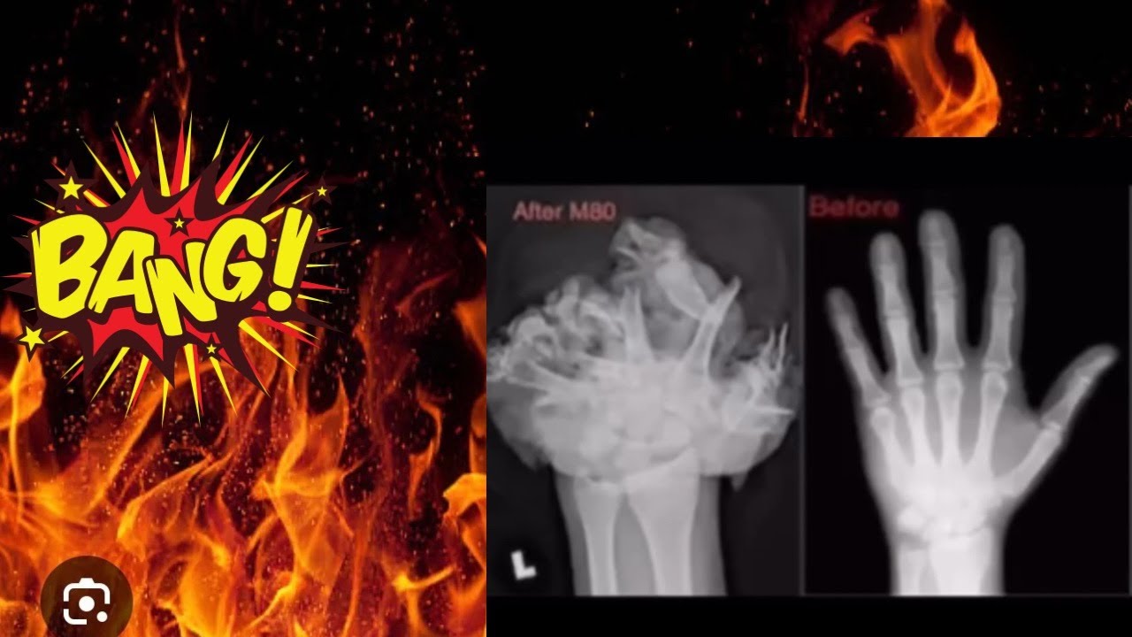 4Xtra Surgery Update: Fingers Gone, Vision in Question — But His Girl ...