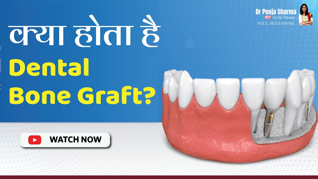 What Is A Dental Bone Graft? Types of Bone Graft | Dental Treatment In ...