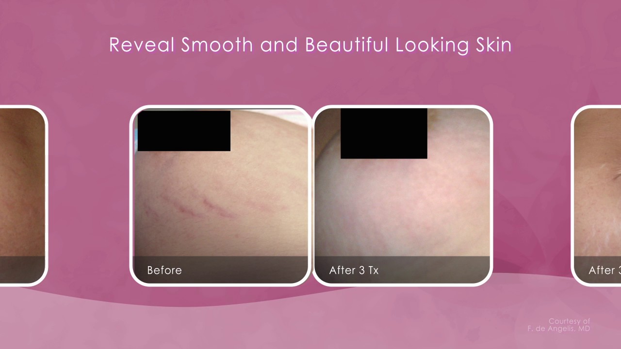 Laser Stretch Mark Removal at SKIN MediSpa - YouTube