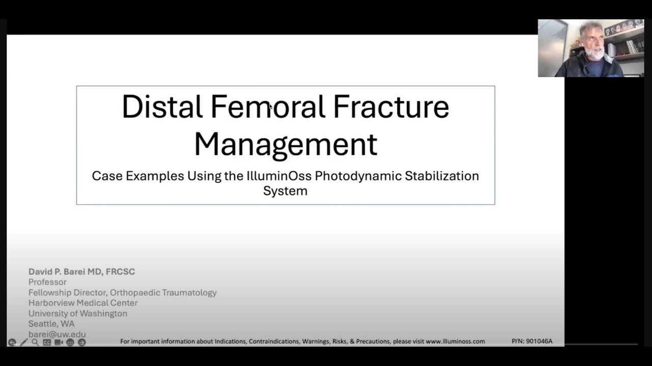 IlluminOss as an augment in the distal femur to aid in early weight ...