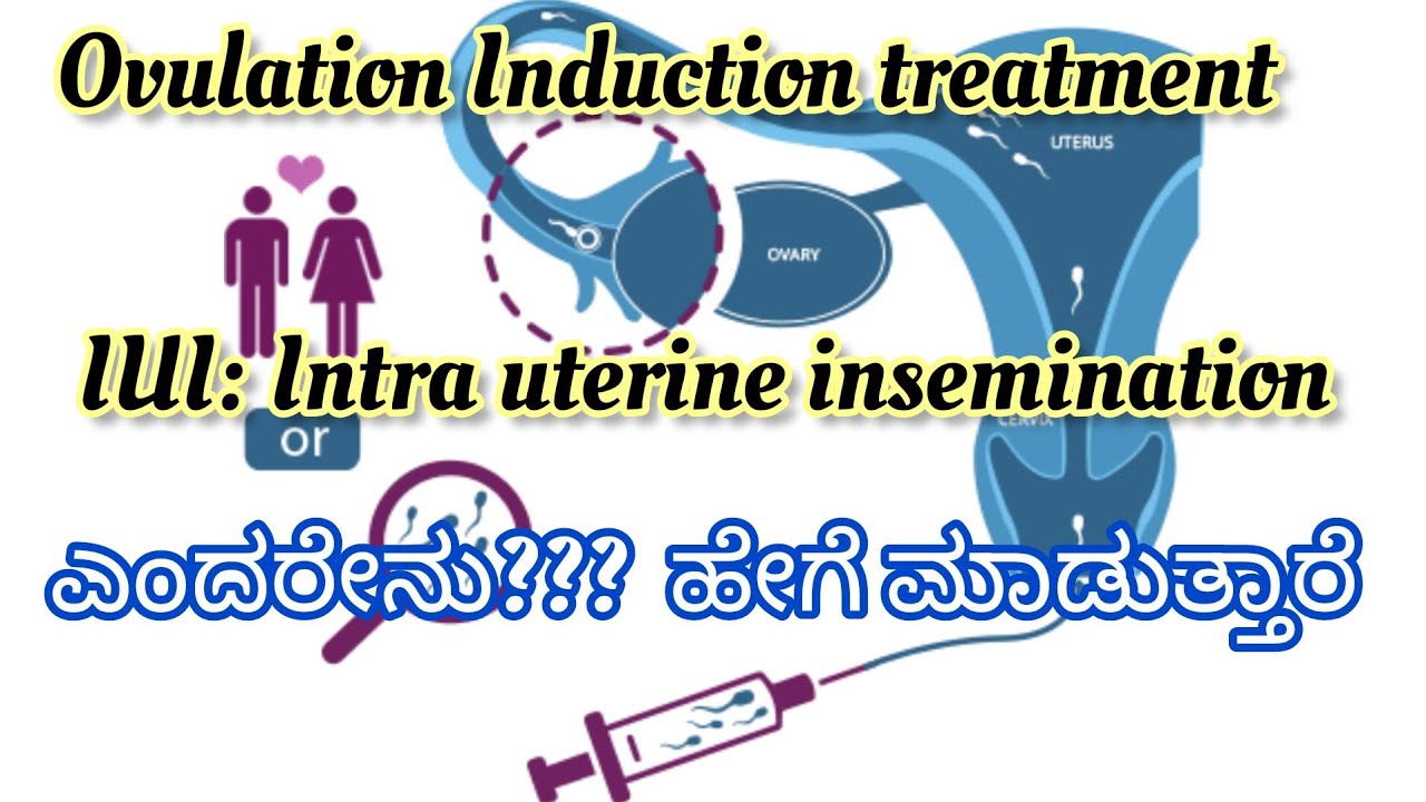 ovulation Induction &IUI treatment ,procedures/ಗರ್ಭಧಾರಣೆಗೆ ಮುನ್ನ ಮಾಡುವ ...