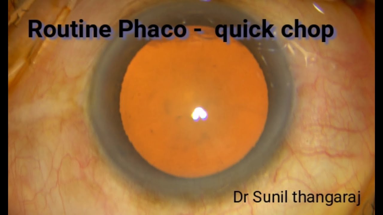 Routine phaco using quick chops - YouTube
