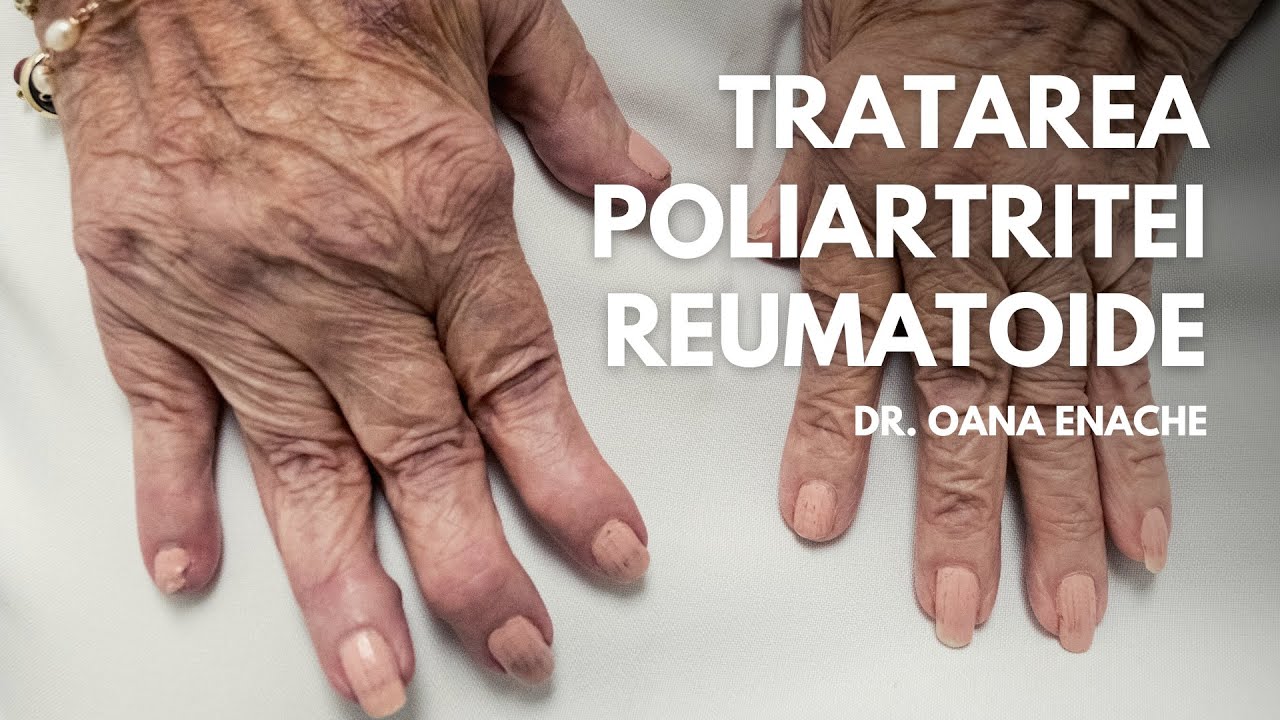 🔴 Poliartrita Reumatoidă: Semne și tratamente eficiente | Dr. Oana ...