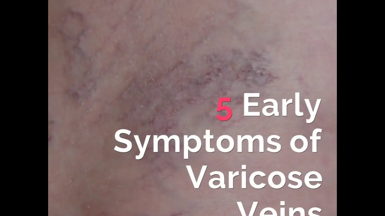 5 Early Symptoms of Varicose Veins - YouTube