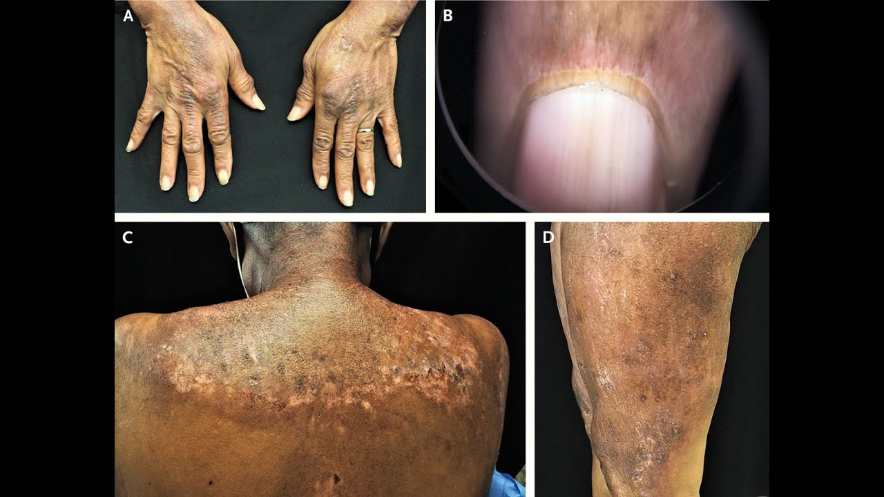 Dermatomyositis - YouTube