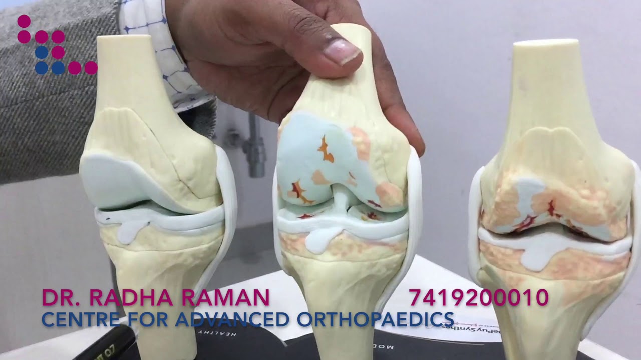 Total Knee Replacement expained with a 3D model - YouTube