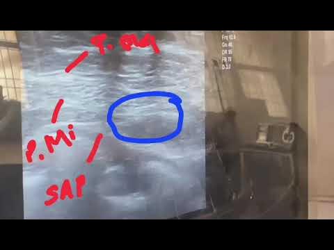 PECS 2 Block Dr Mayank chansoria Professor HOD Emergency Medicine Jabalpur MP - YouTube