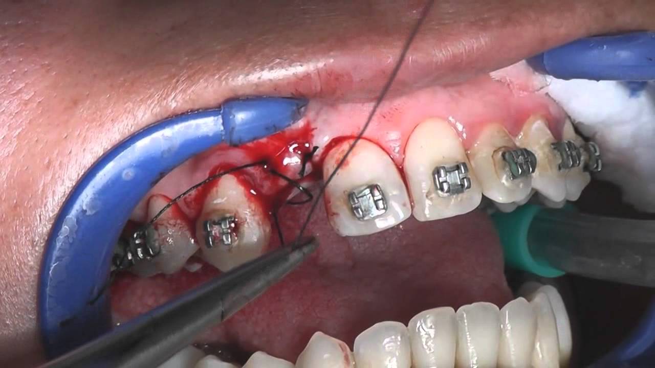 Single Tooth Crest Split & Ridge Widening at an Upper Lateral Incisor ...