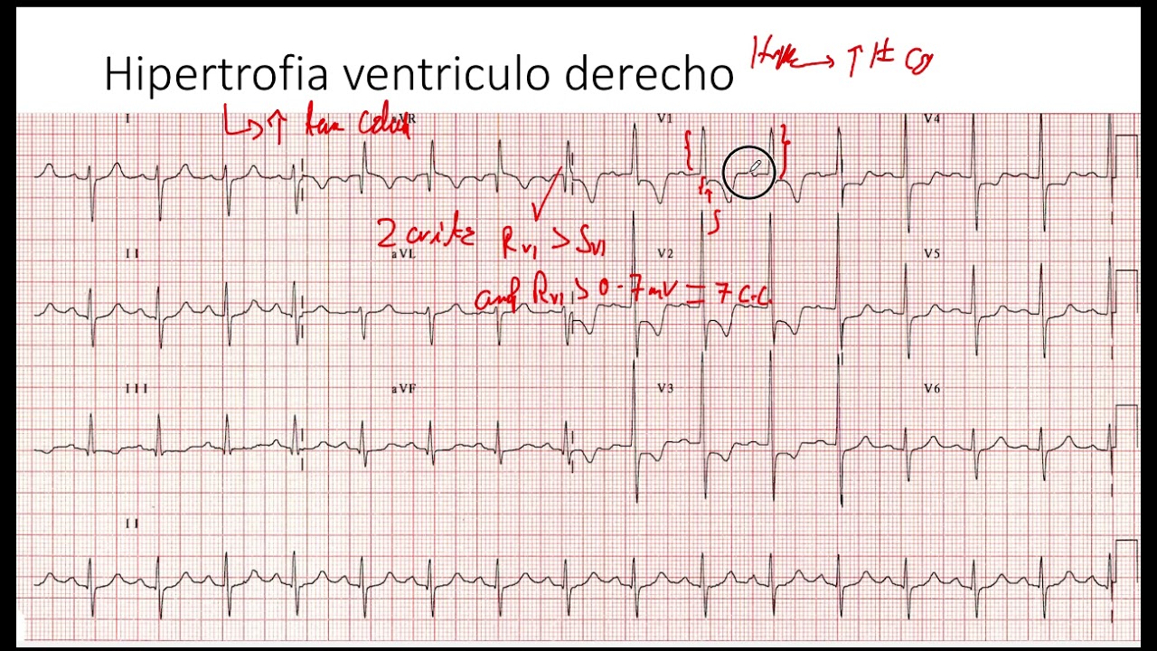 Hipertrofia Ventriculo Derecho - YouTube