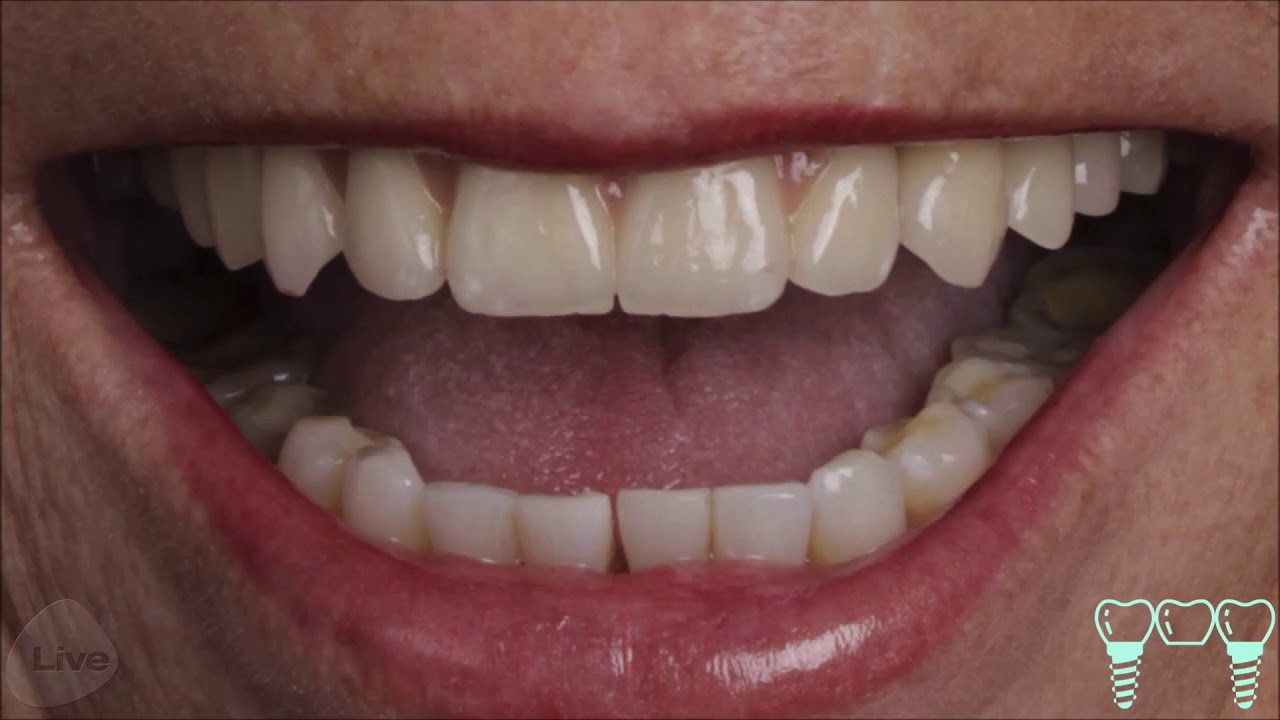 IMPLANTE PONTE FIXA FINAL - YouTube