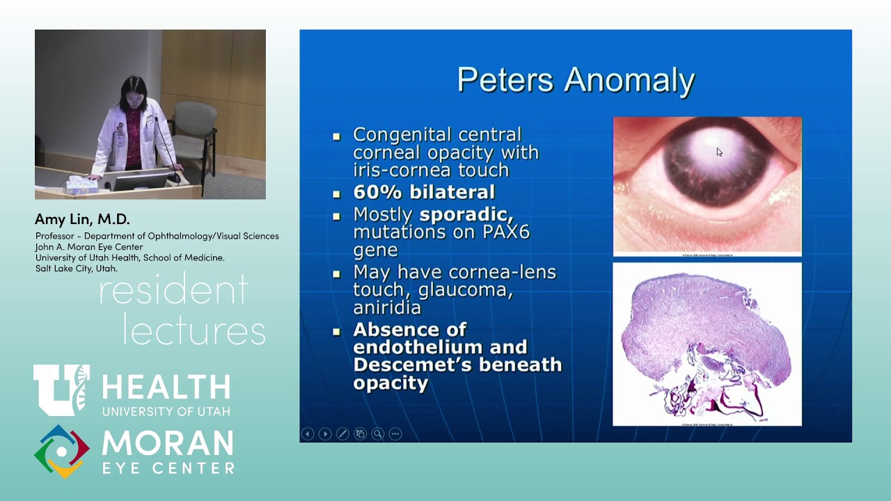 Congenital Anomalies of the Cornea, Sclera and Globe - YouTube