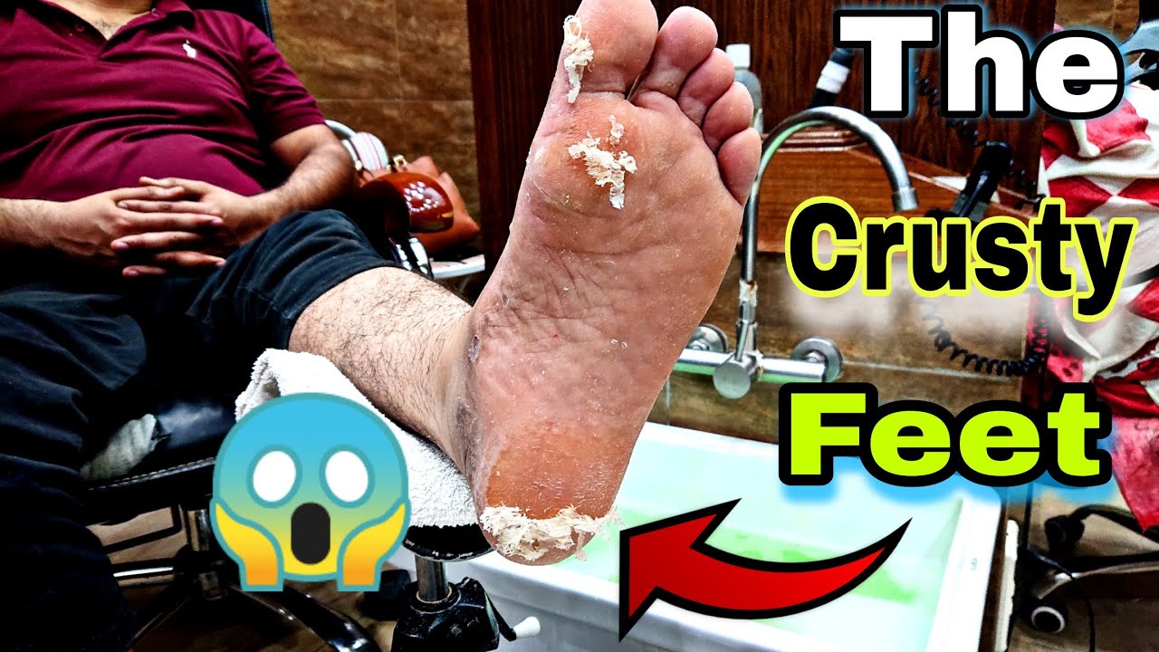 Pedicure,Crusty, tutorial, Scrape setp by step, Complected Condition ...