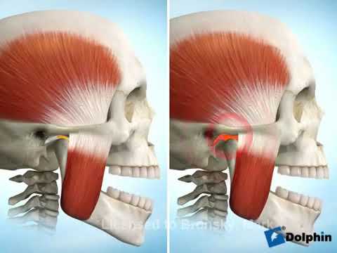 ATM deslocamento disco articular - YouTube