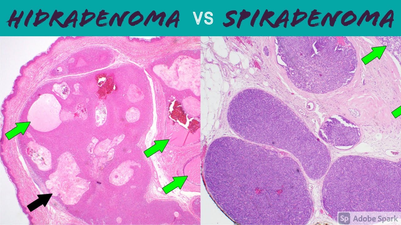 Hidradenoma (Acrospiroma) vs Spiradenoma/Cylindroma: 5-Minute Pathology ...
