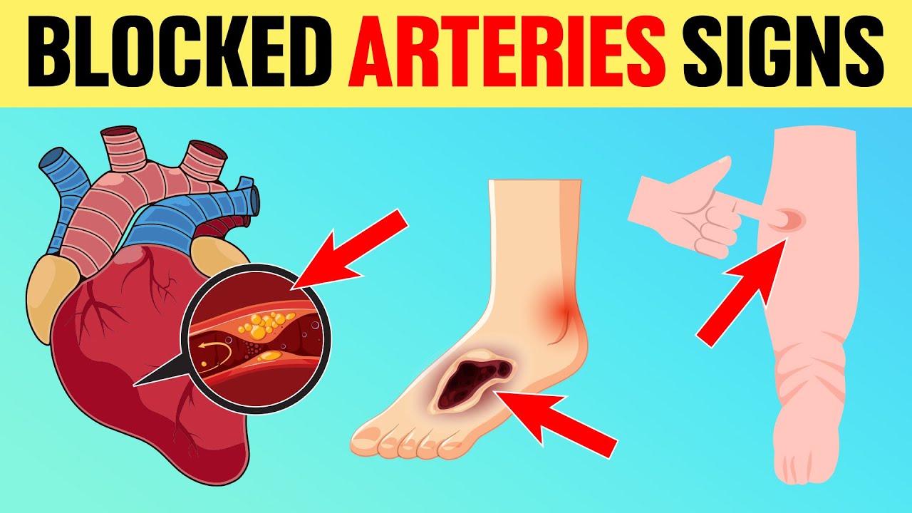 9 Warning Signs Of Blocked Arteries In Your Hands And Feet (Don't ...