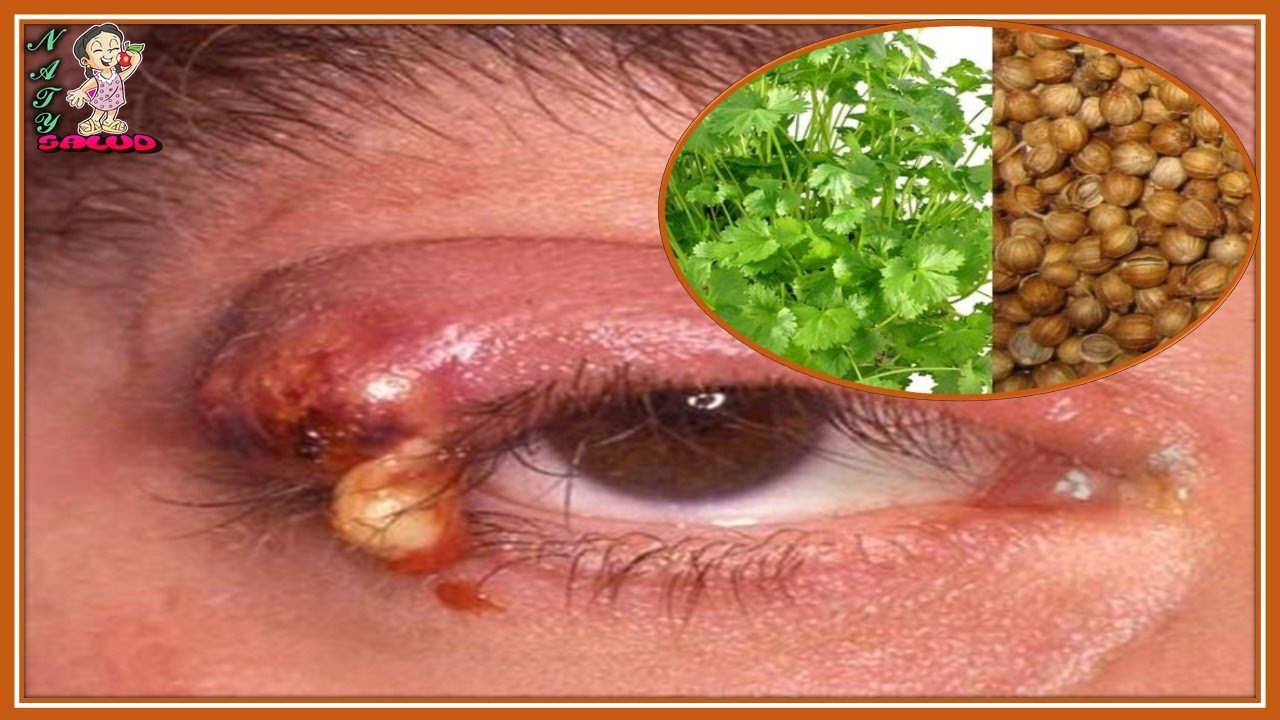 Tratamientos caseros para quitar la infección en el ojo, o el orzuelo ...