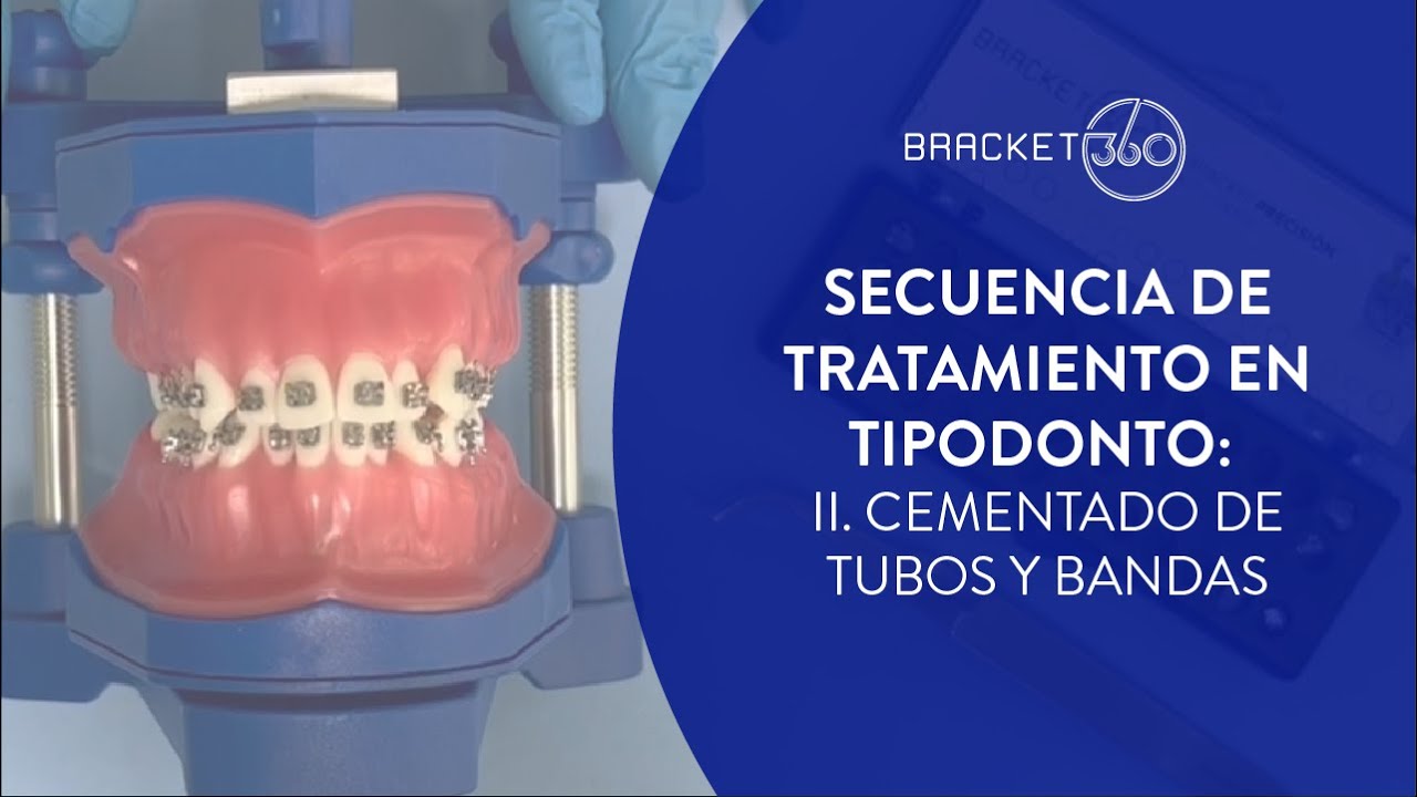 Cementado de Tubos y Bandas - Parte 2🦷 Secuencia de tratamiento en ...