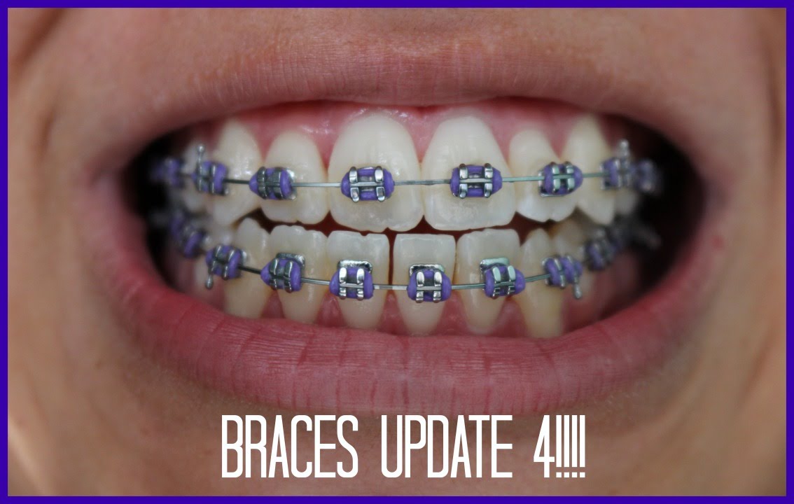 BRACES UPDATE #4!!! - YouTube