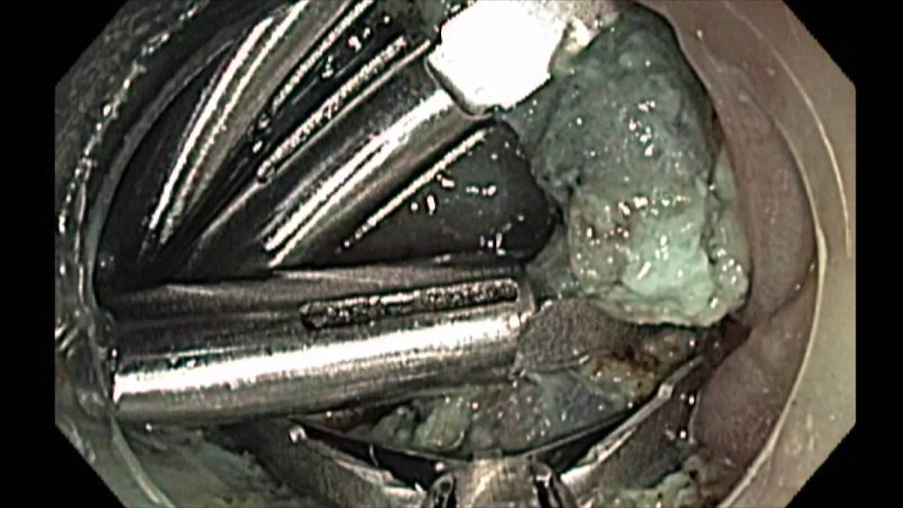 Colonoscopy:Colonoscopy: Ascending Colon Giant Polyp Resection - step 5 ...