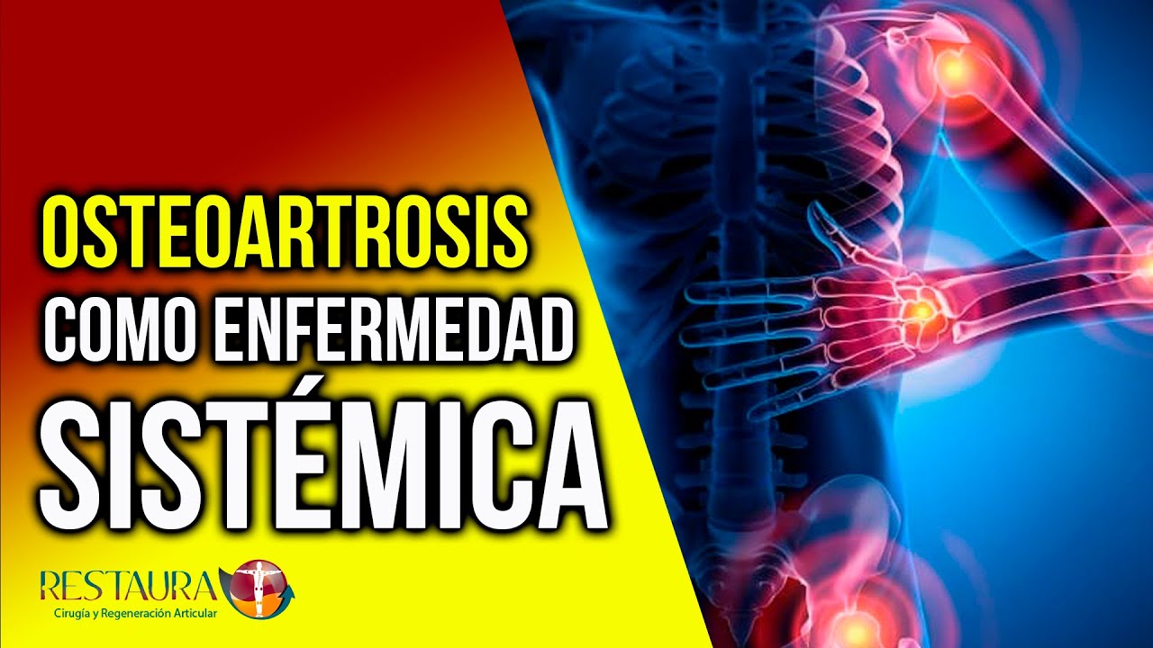 Osteoartrosis como enfermedad sistémica - Enfermedad Articular ...