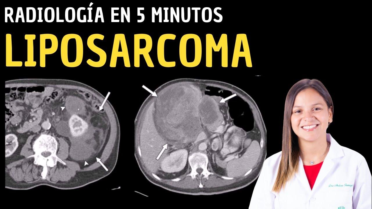 Radiología en 5 minutos: Liposarcoma. - YouTube