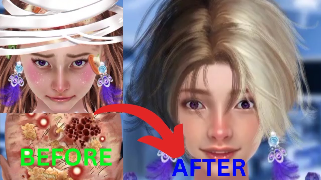 ASMR Giant hardened flakes dandruff removal at hairline | Scalp ...