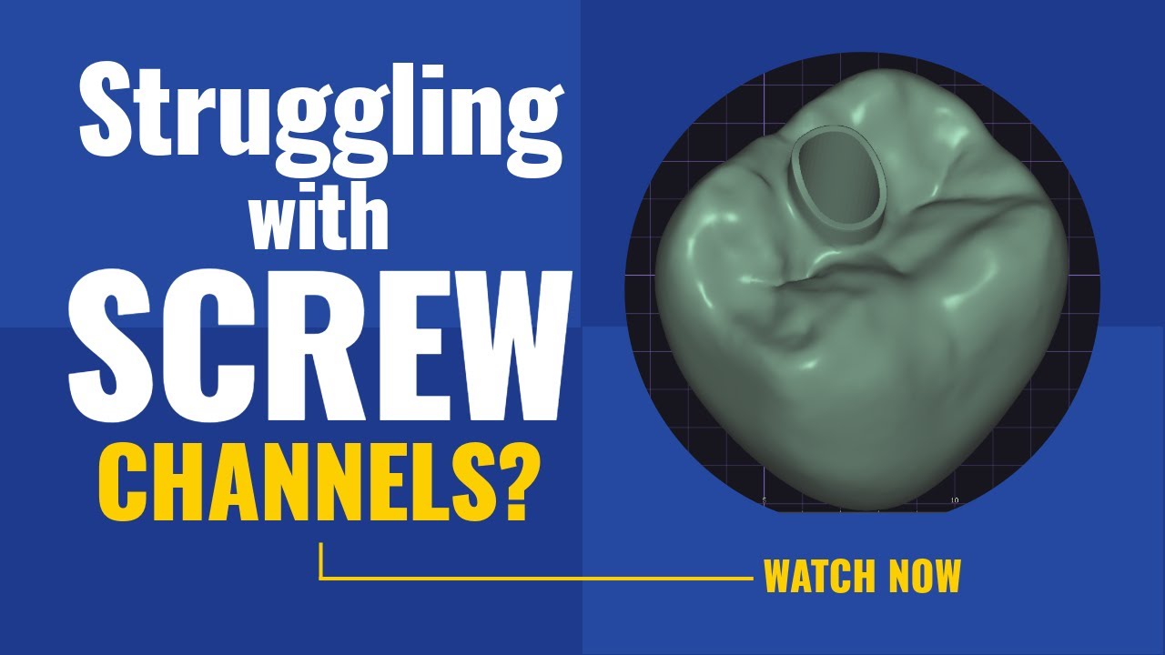 Struggling with screw channels in Exocad - YouTube