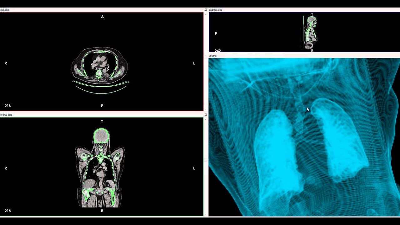 3d dicom viewer - YouTube