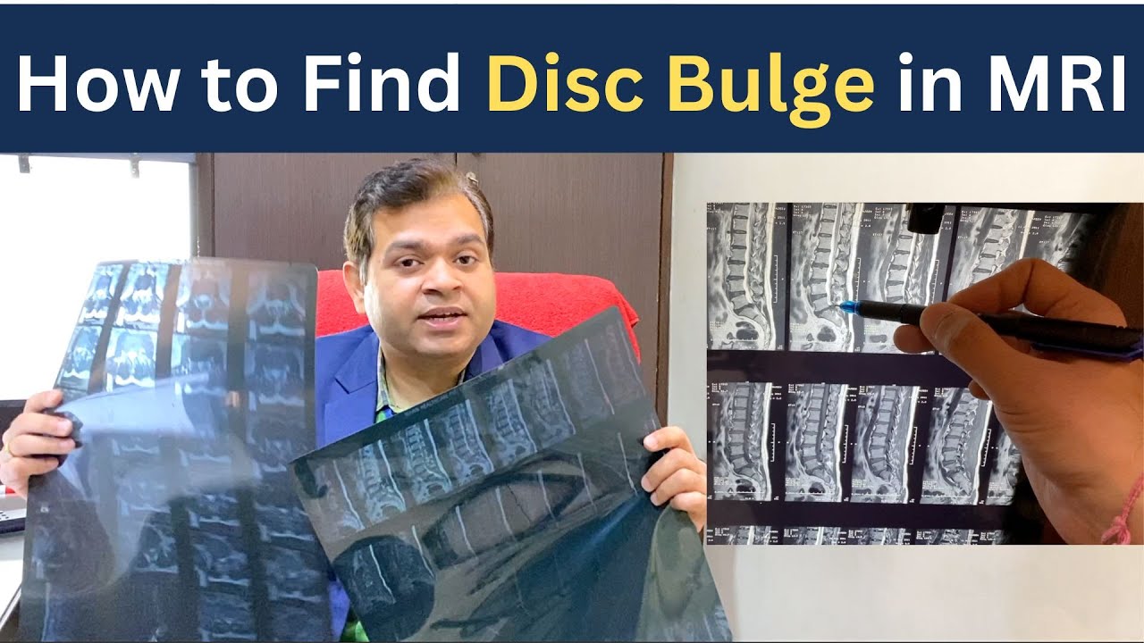 L4-L5-S1 Disc Bulge in Lumbar Spine MRI, Sciatica & Herniated Disc MRI ...