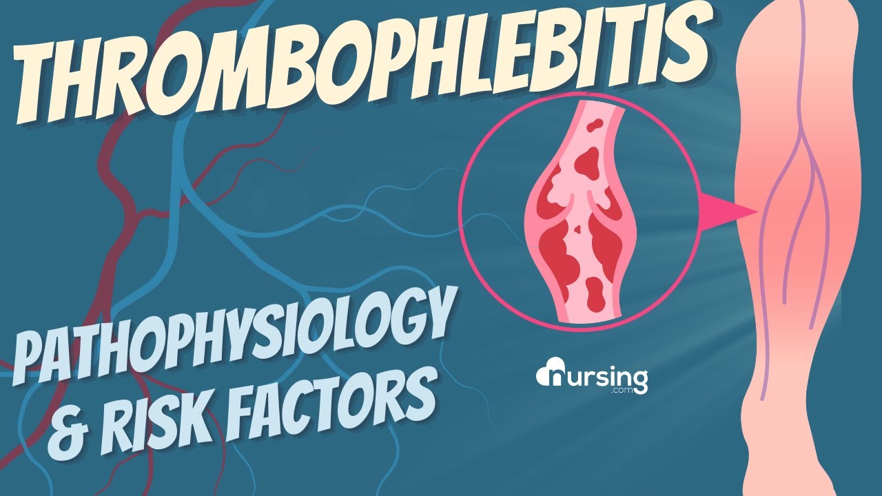 Thrombophlebitis: Pathophysiology & Risk Factors- Nursing - YouTube