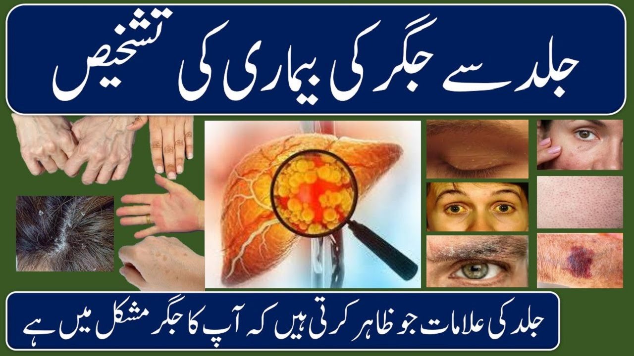 Skin is Warning You About Liver Problems | Signs, Prevention ...